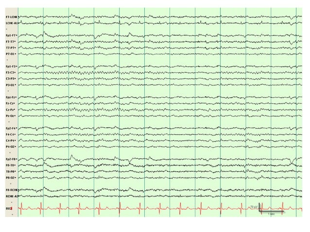 EEG Variants with patterns by Murtaza Syed | PPT | Brain and Nervous ...