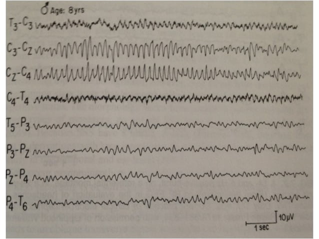 EEG Variants with patterns by Murtaza Syed | PPT | Brain and Nervous ...