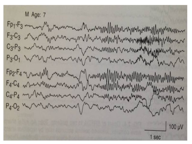 EEG Variants with patterns by Murtaza Syed | PPT | Brain and Nervous ...