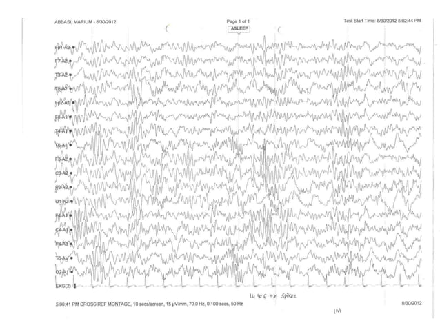 EEG Variants with patterns by Murtaza Syed | PPT | Brain and Nervous ...
