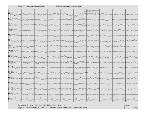 EEG Variants with patterns by Murtaza Syed