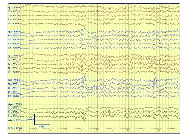 Eeg Variants With Patterns By Murtaza Syed