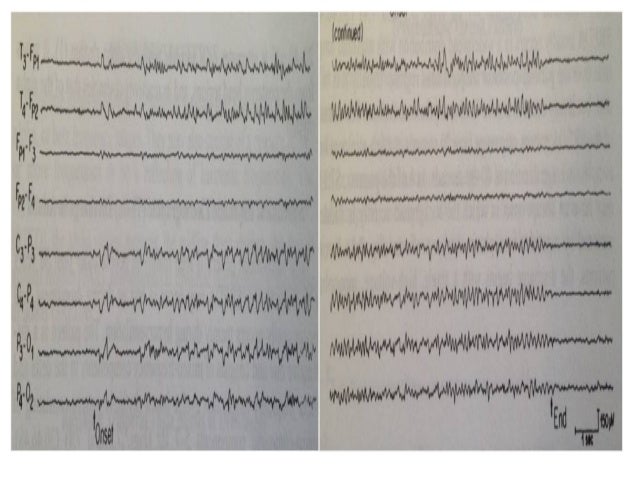 Eeg Variants With Patterns By Murtaza Syed