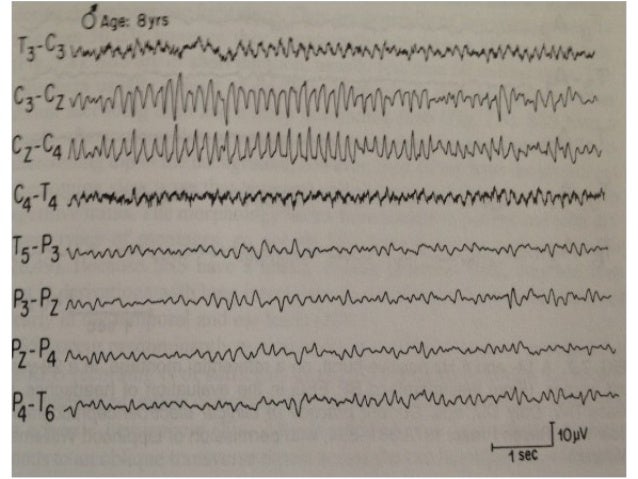 Eeg Variants With Patterns By Murtaza Syed