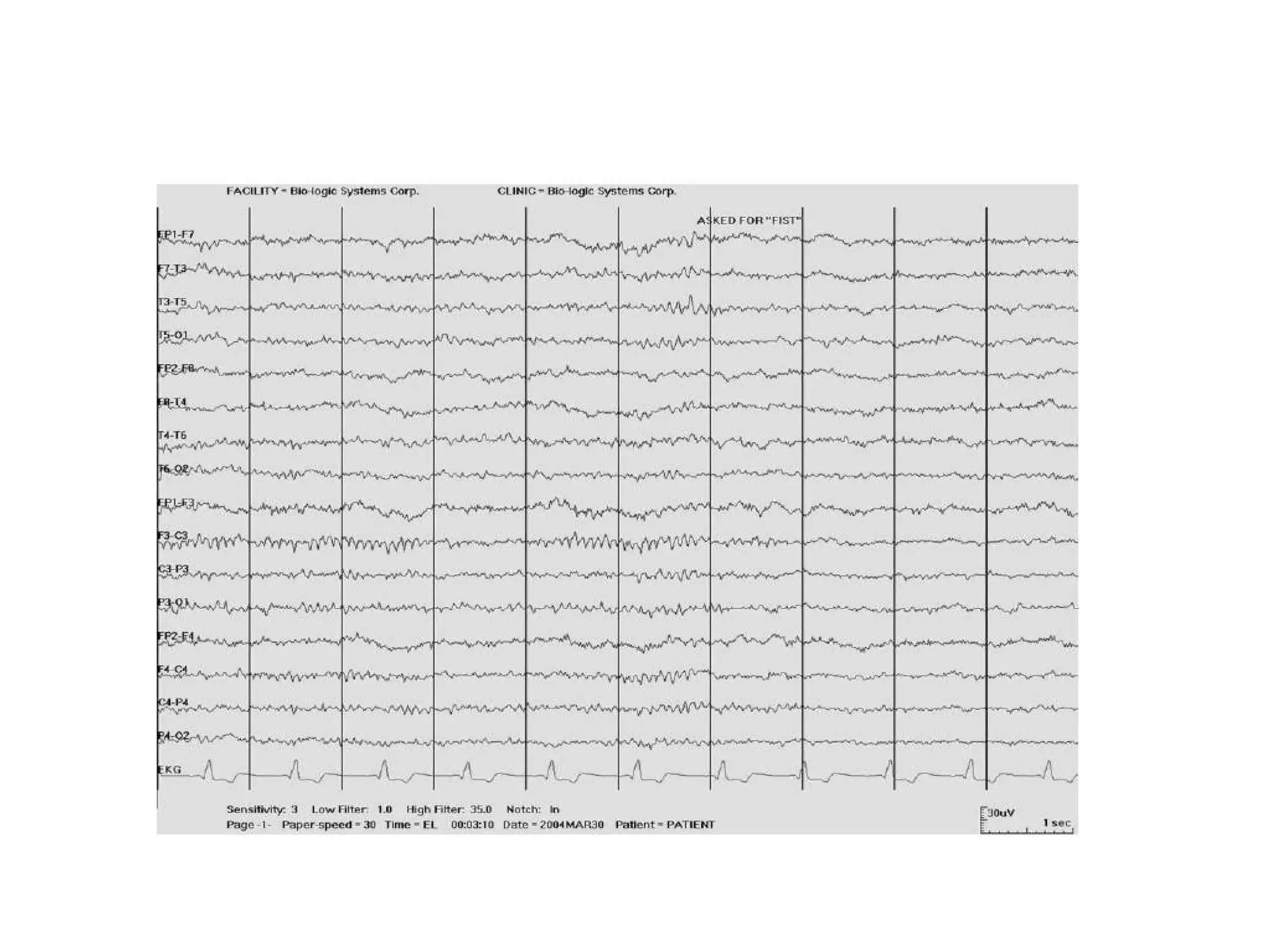 Normal Eeg Variants By Faizan Abdullah Ppt