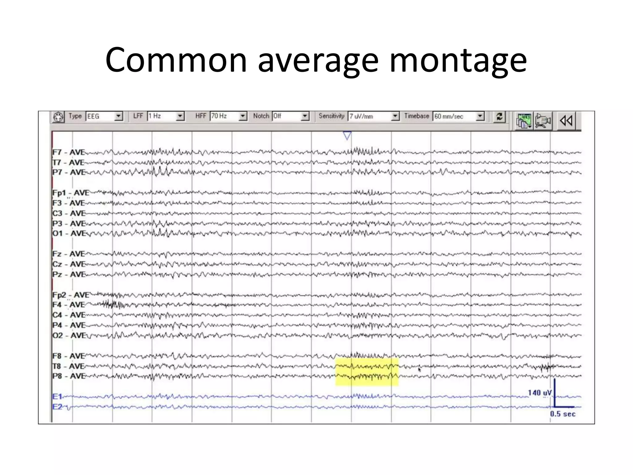 Normal eeg variants by faizan abdullah | PPT