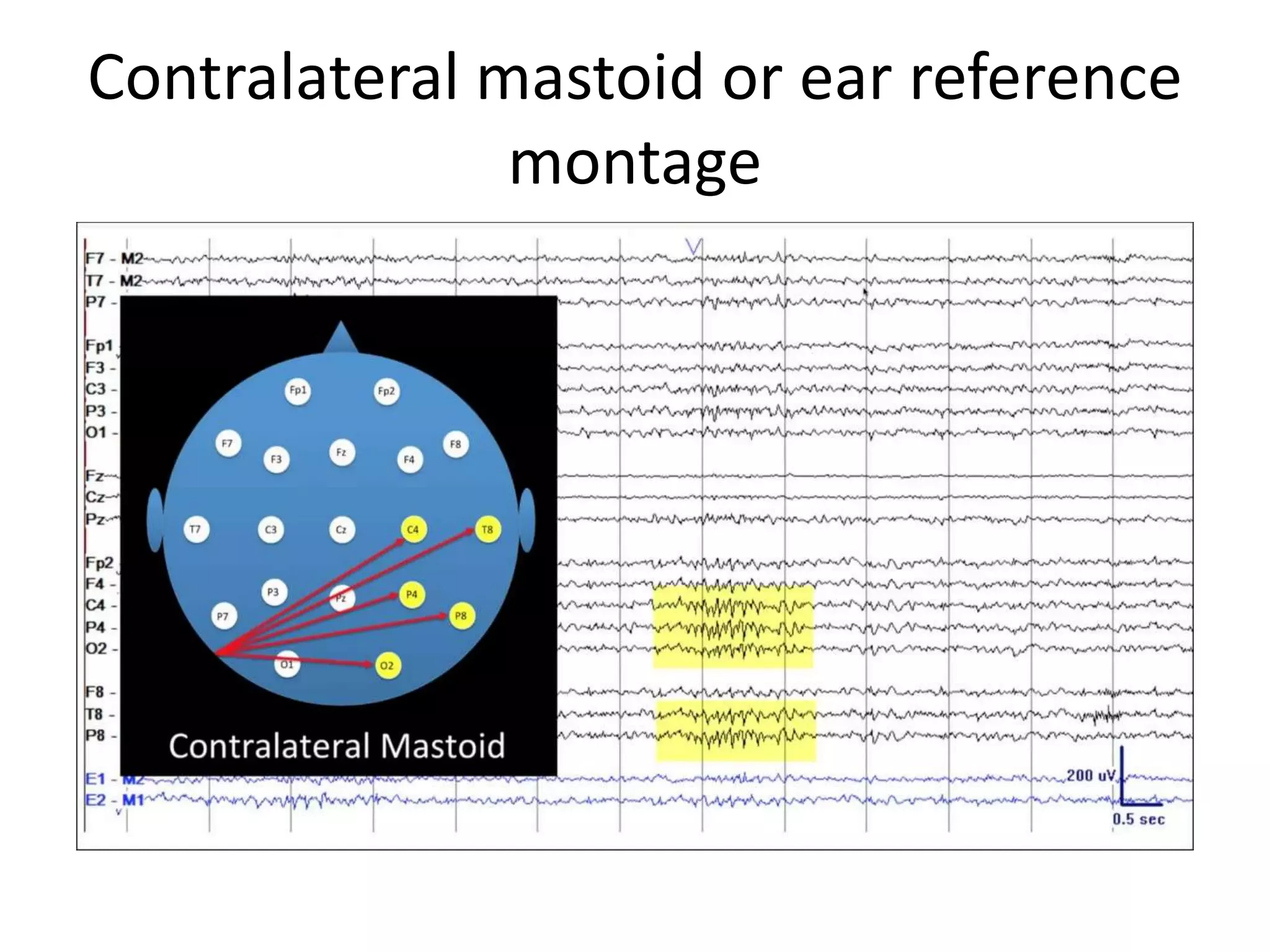 Normal Eeg Variants By Faizan Abdullah Ppt
