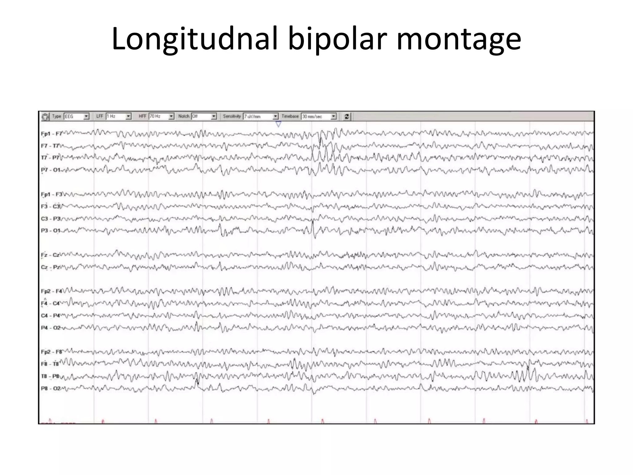 Normal Eeg Variants By Faizan Abdullah Ppt