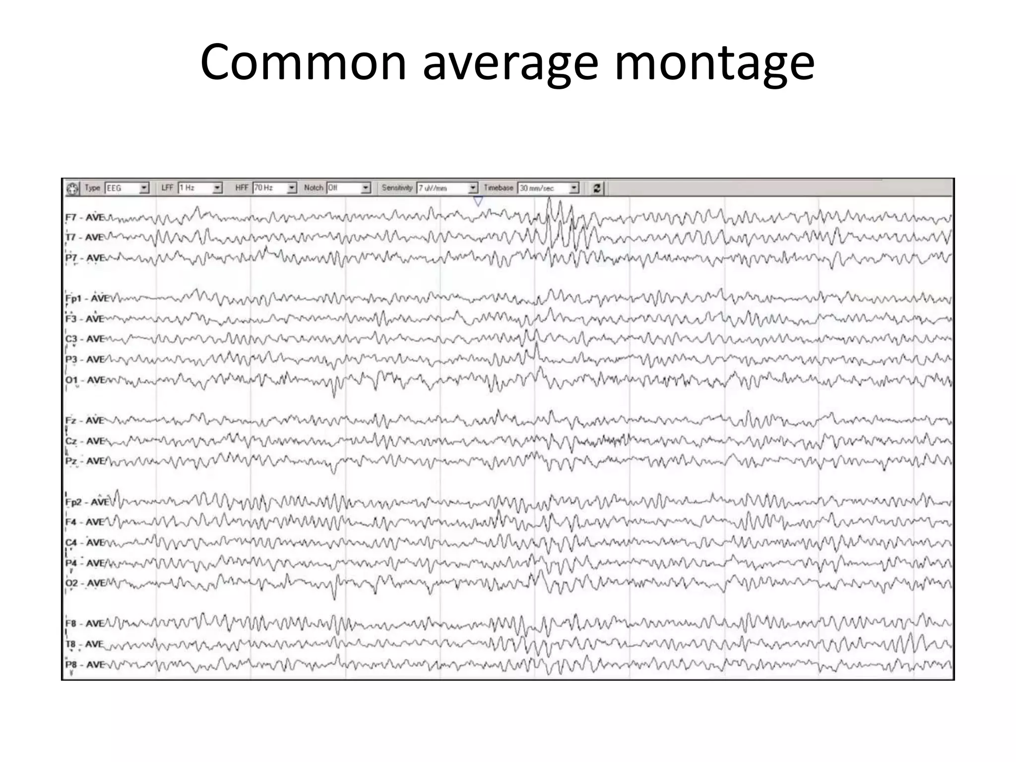 Normal Eeg Variants By Faizan Abdullah Ppt