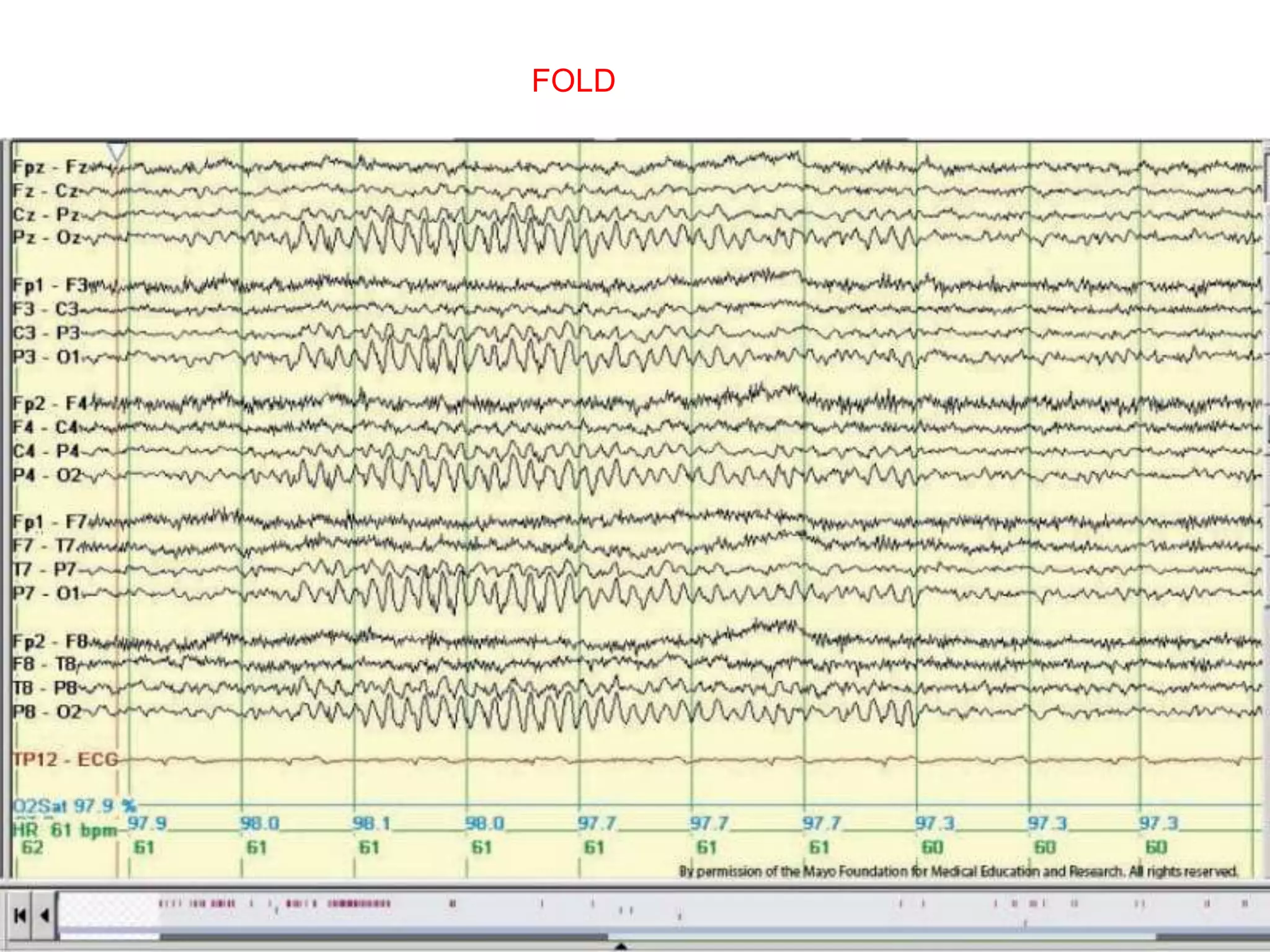 Normal Eeg Variants By Faizan Abdullah Ppt