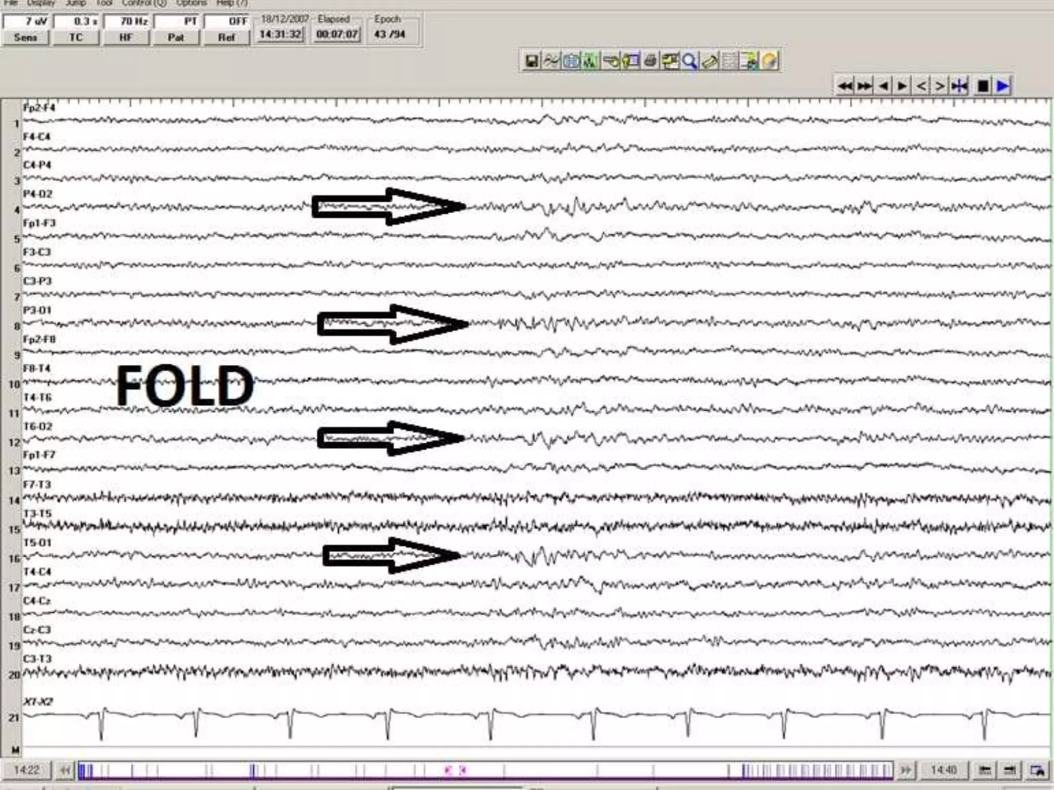 Normal Eeg Variants By Faizan Abdullah Ppt