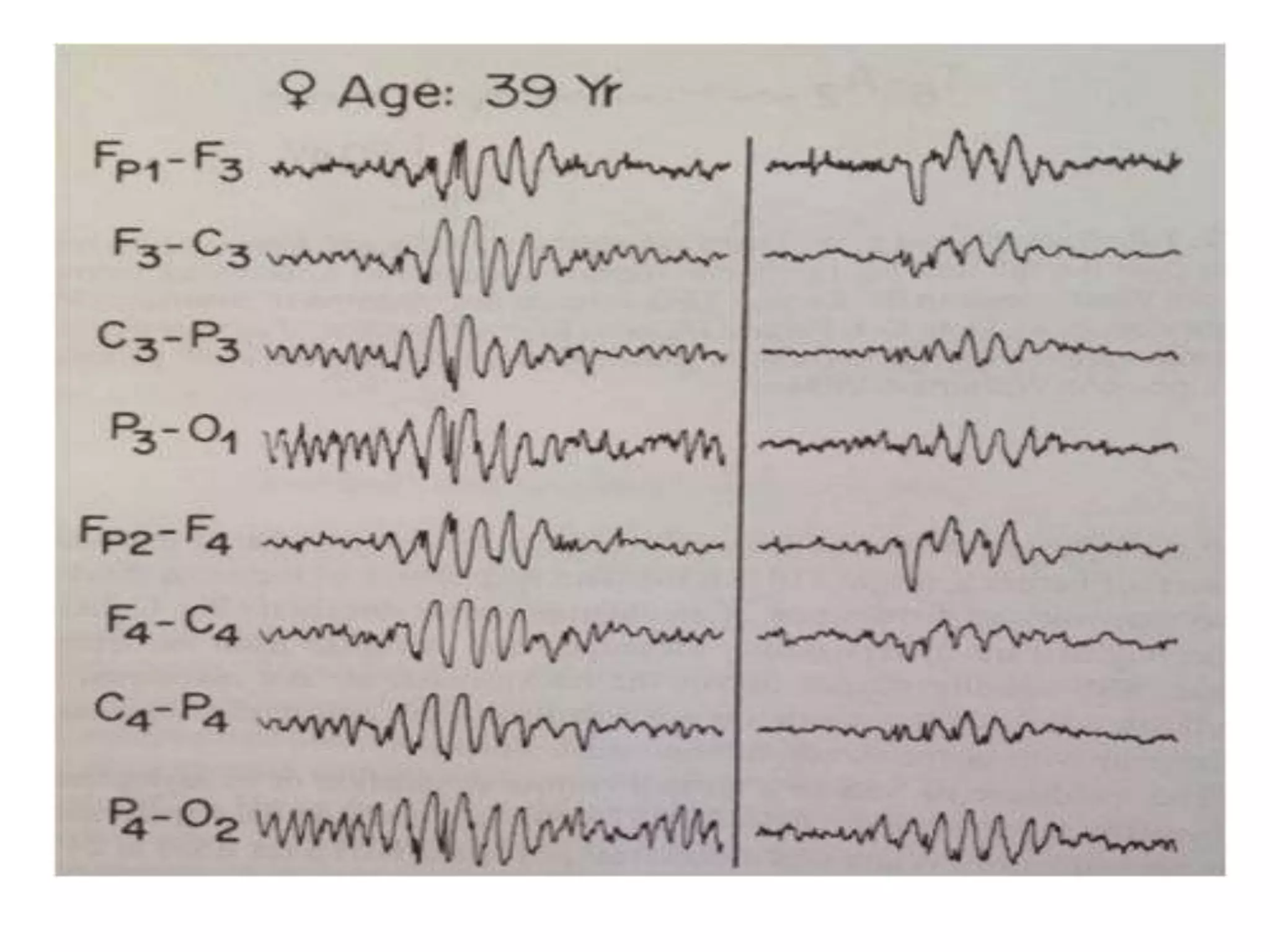 Normal eeg variants by faizan abdullah | PPT