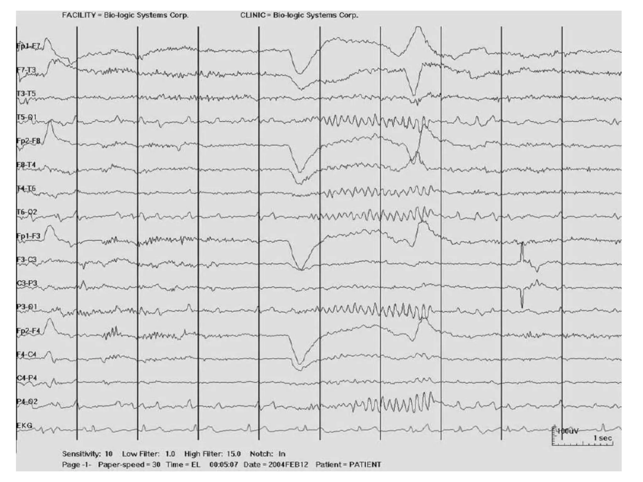 Normal Eeg Variants By Faizan Abdullah Ppt