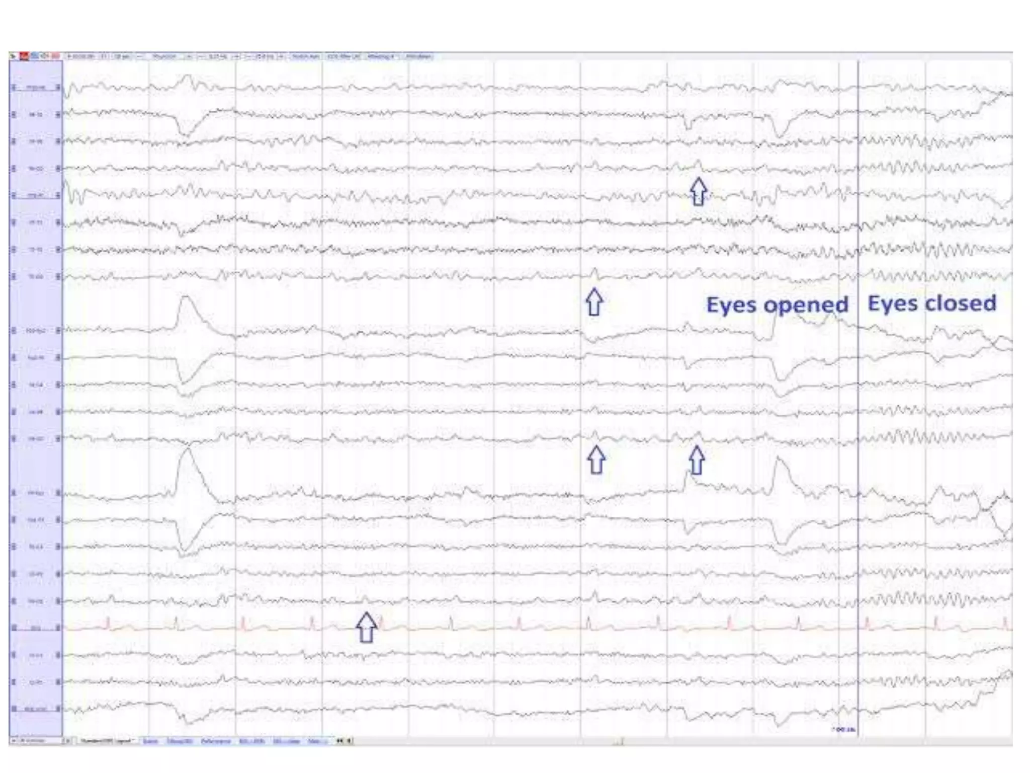 Normal eeg variants by faizan abdullah | PPT