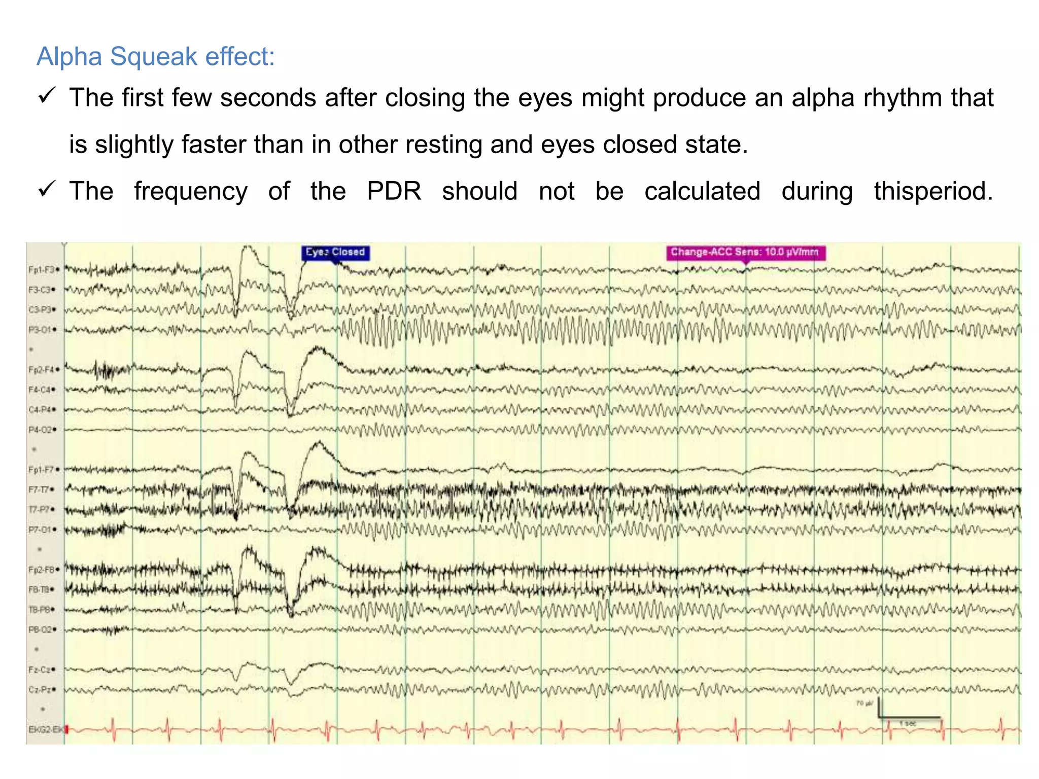 Normal eeg variants by faizan abdullah | PPT