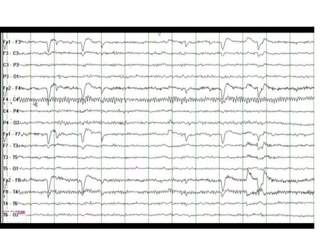 Normal eeg variants by faizan abdullah | PPT