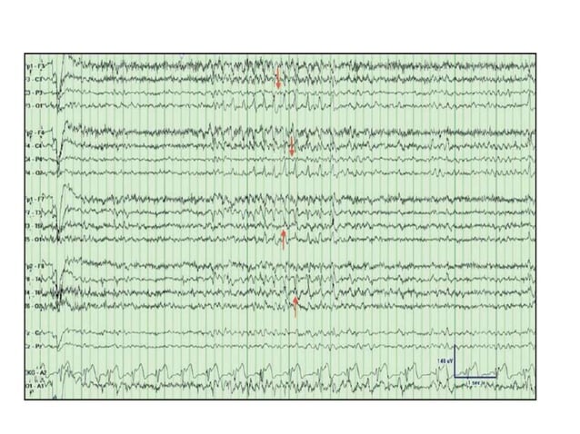 Normal eeg variants by faizan abdullah | PPT