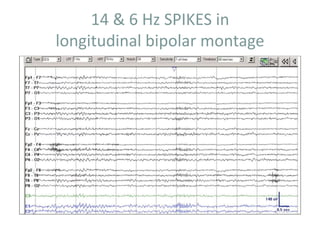 Normal eeg variants by faizan abdullah | PPT