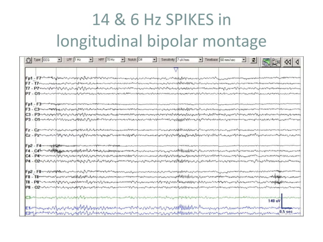 Normal eeg variants by faizan abdullah | PPT