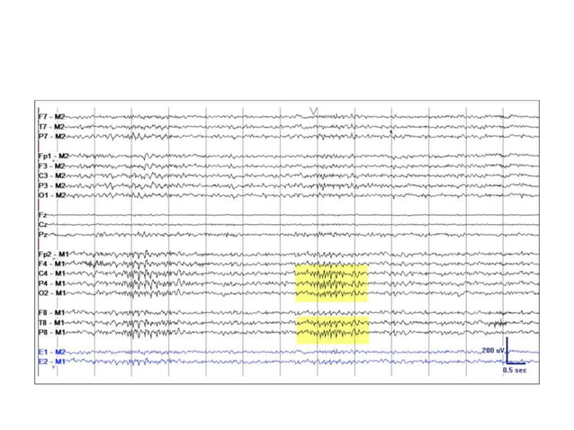 Normal eeg variants by faizan abdullah | PPT