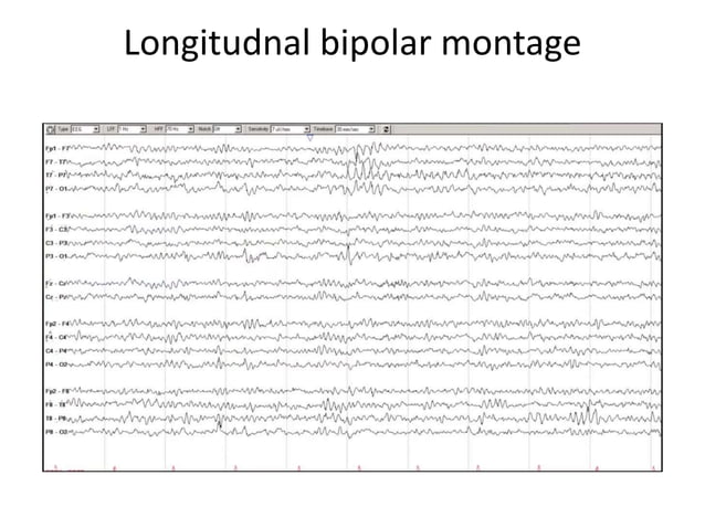 Normal eeg variants by faizan abdullah | PPT