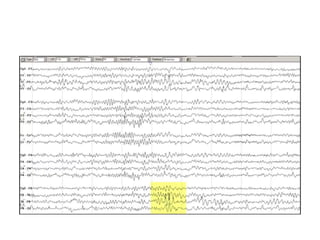 Normal eeg variants by faizan abdullah | PPT