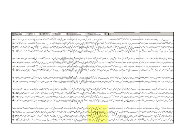 Normal eeg variants by faizan abdullah | PPT