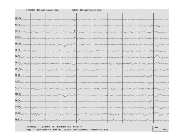 Normal eeg variants by faizan abdullah | PPT