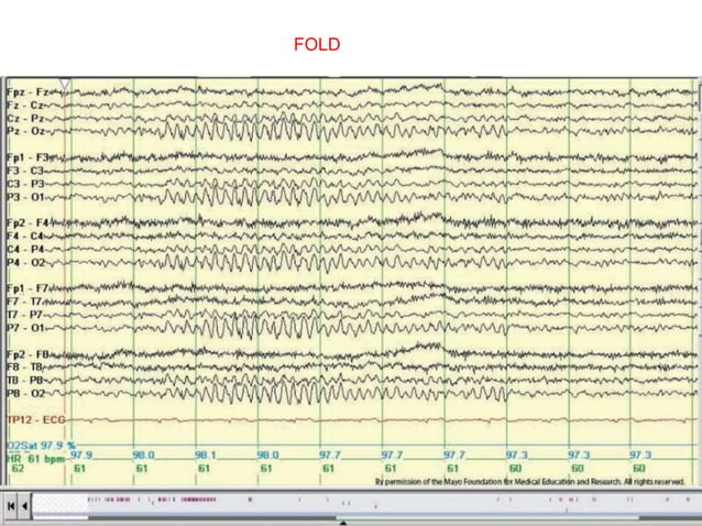 Normal eeg variants by faizan abdullah | PPT