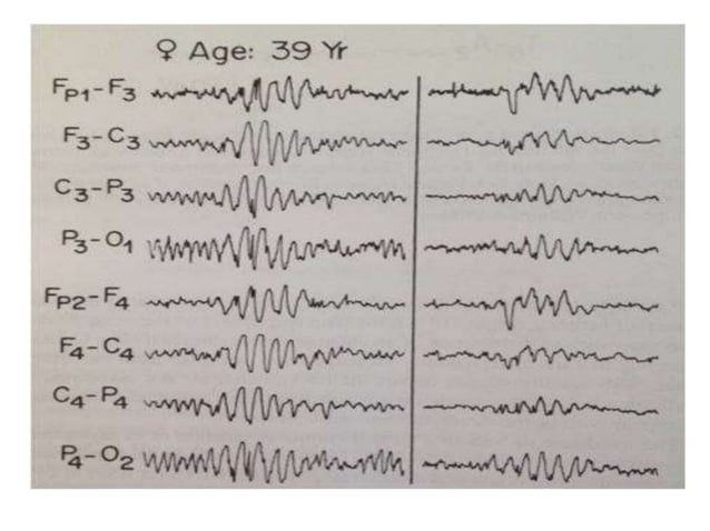 Normal eeg variants by faizan abdullah | PPT