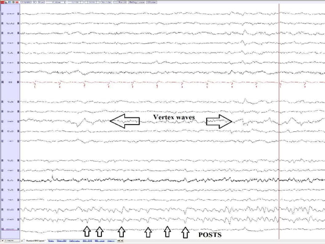 Normal eeg variants by faizan abdullah | PPT