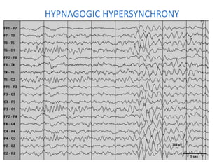 Normal eeg variants by faizan abdullah | PPT