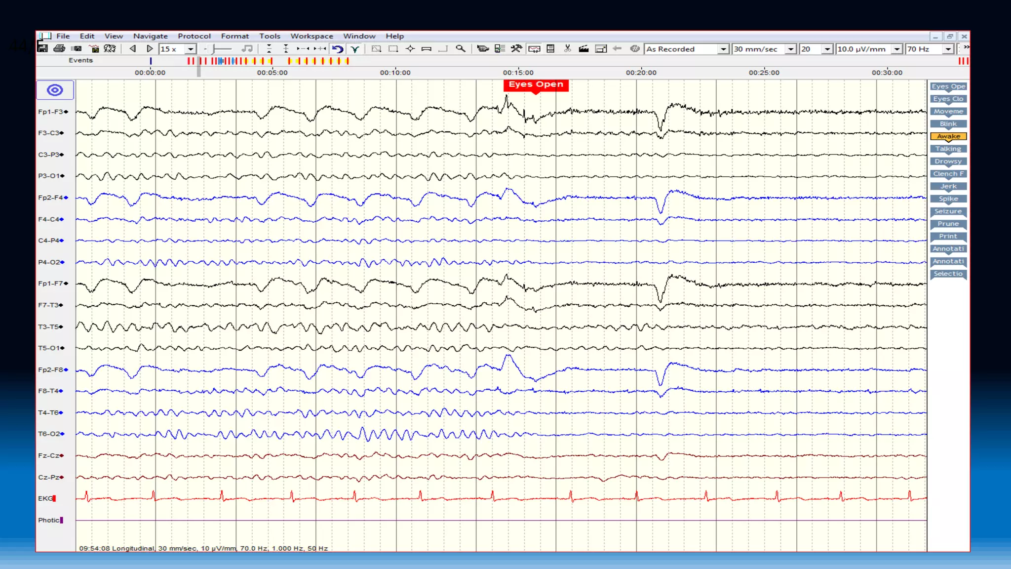 Normal EEG waveforms.pptx | Brain and Nervous System Disorders ...