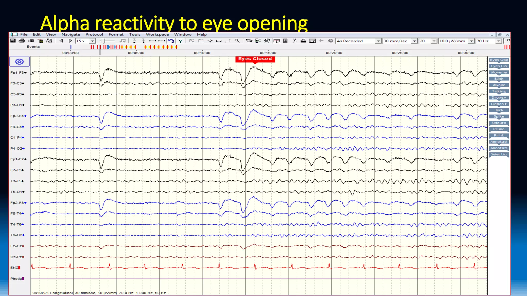 Normal EEG waveforms.pptx