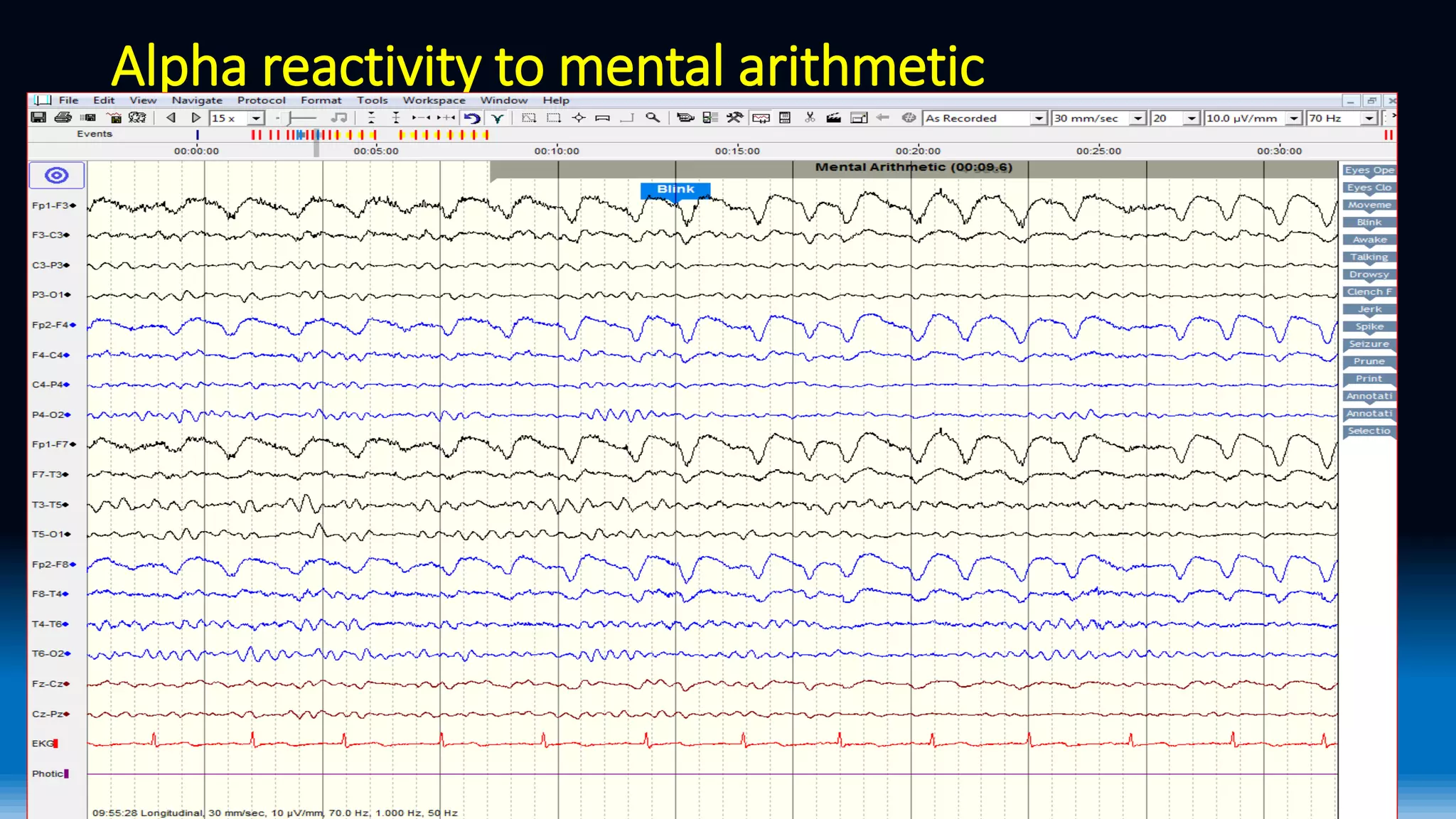 Normal EEG waveforms.pptx