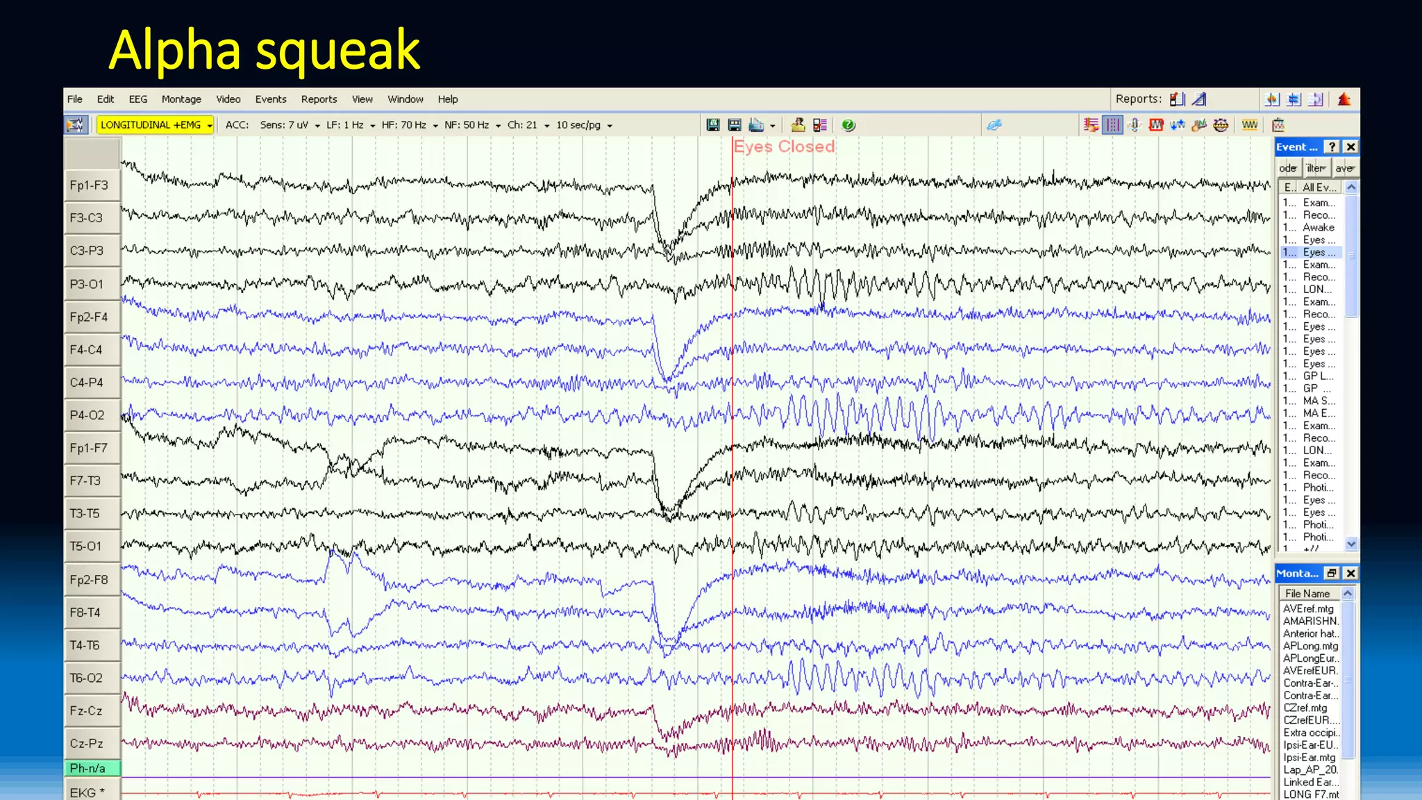 Normal EEG waveforms.pptx