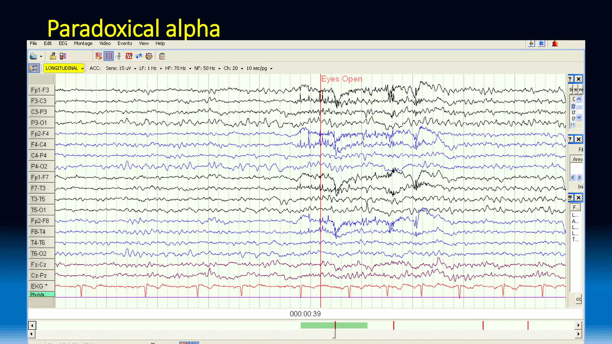 Normal EEG waveforms.pptx