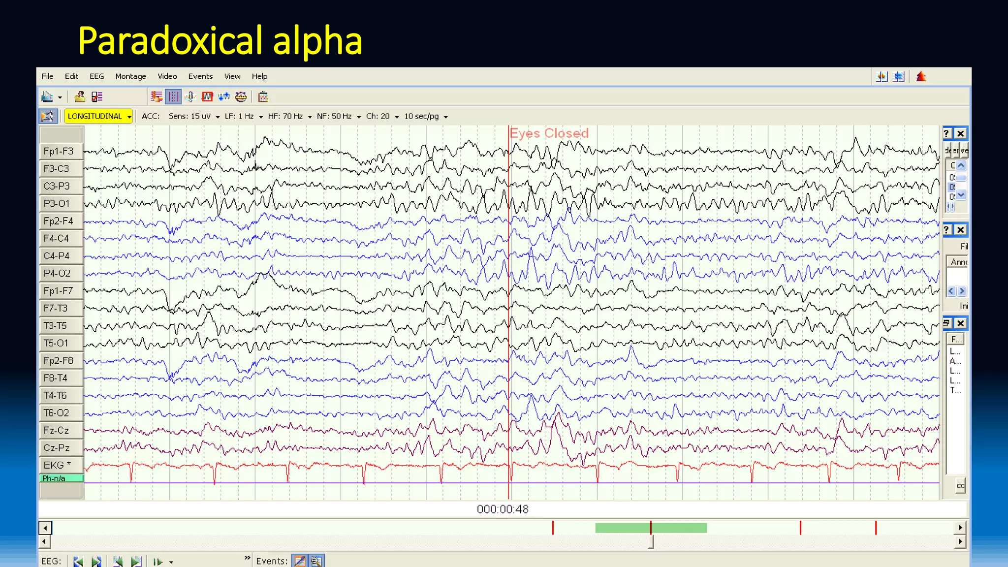 Normal EEG waveforms.pptx