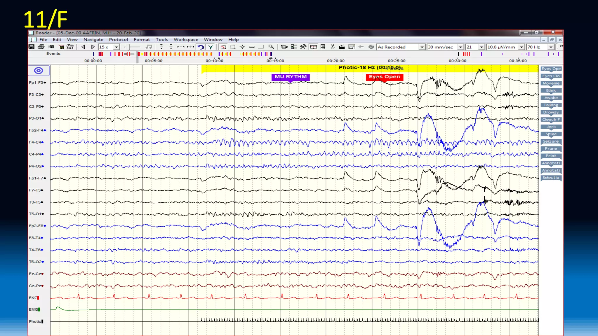 Normal EEG waveforms.pptx