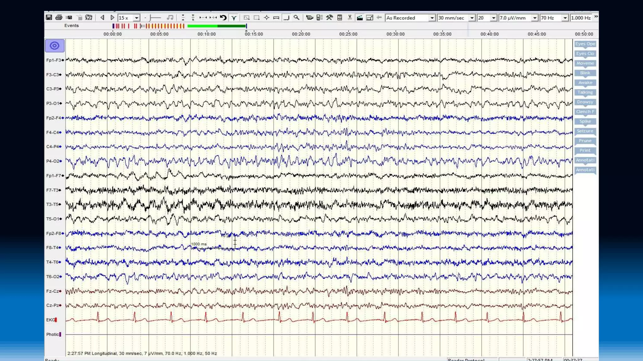Normal EEG waveforms.pptx | Brain and Nervous System Disorders | Diseases and Conditions