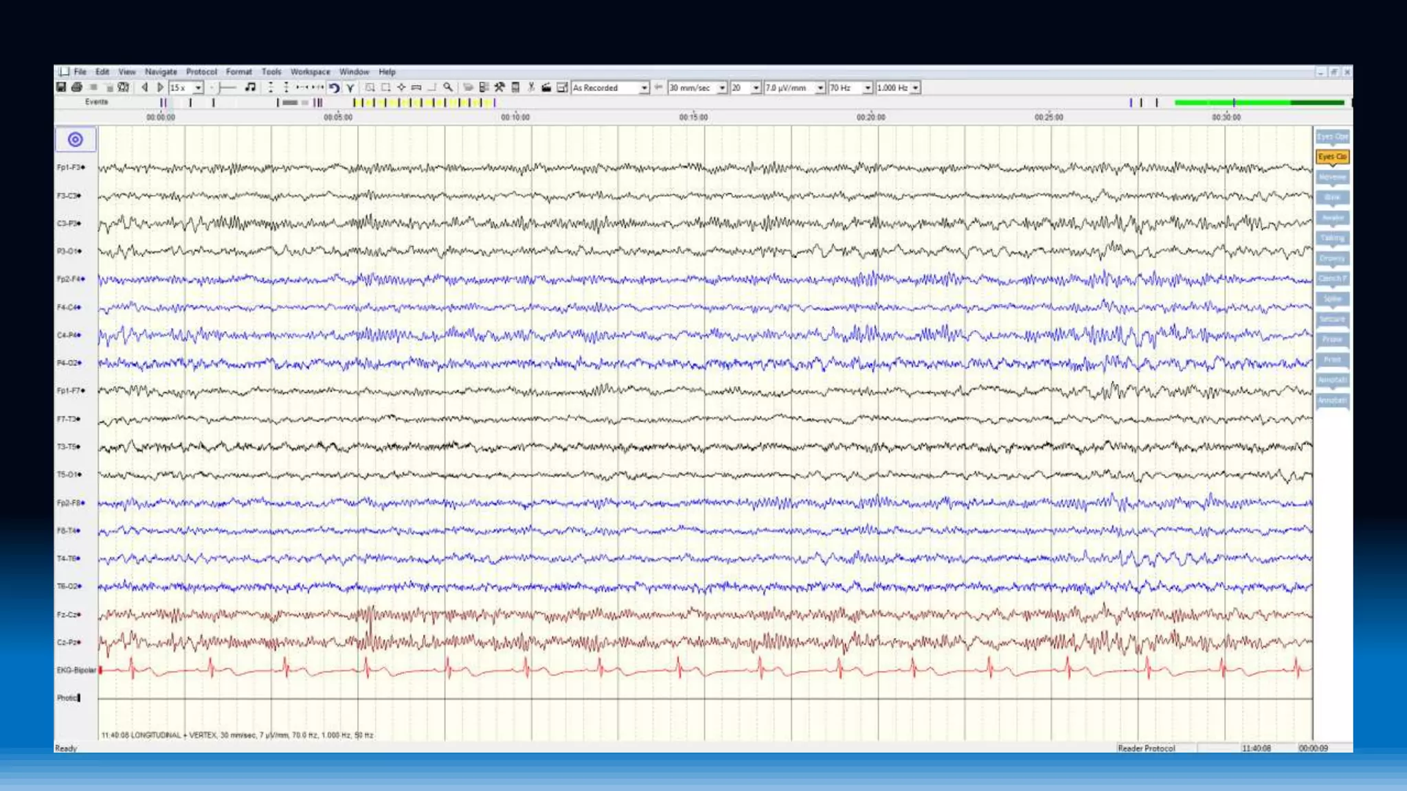 Normal EEG waveforms.pptx | Brain and Nervous System Disorders ...