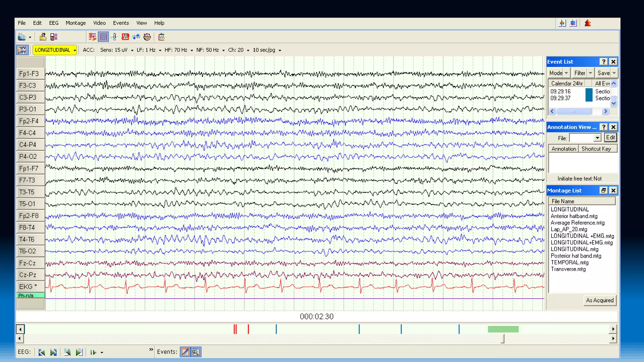 Normal EEG waveforms.pptx | Brain and Nervous System Disorders | Diseases and Conditions
