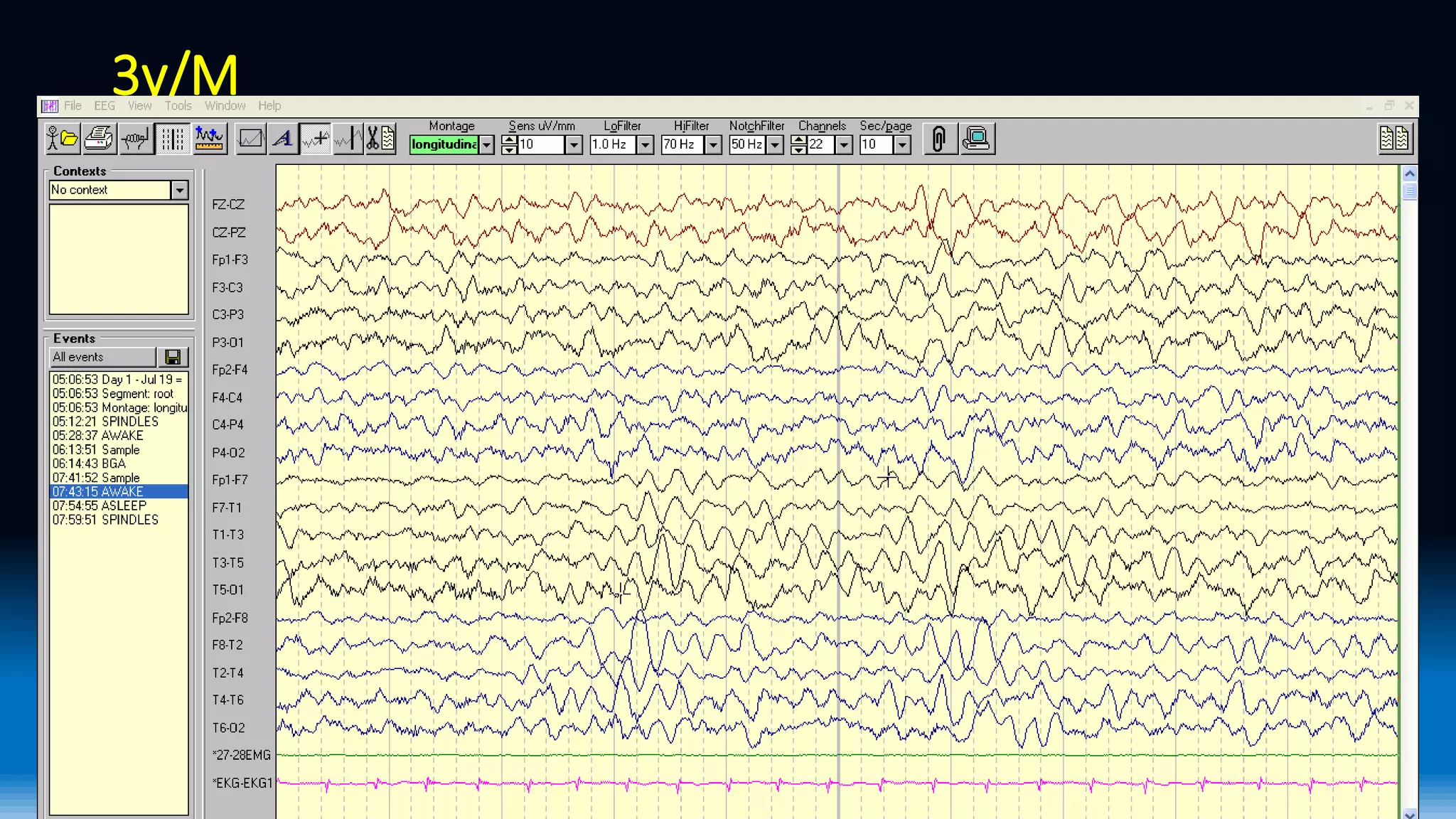 Normal EEG waveforms.pptx
