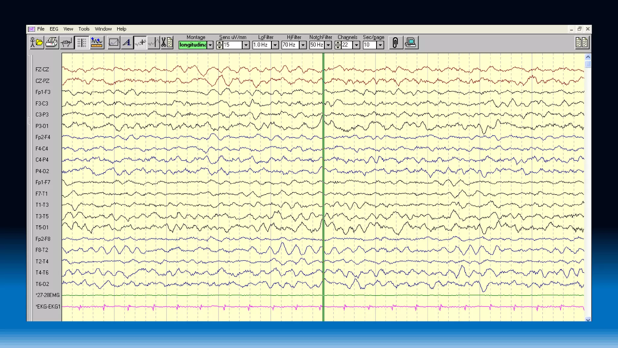 Normal EEG waveforms.pptx