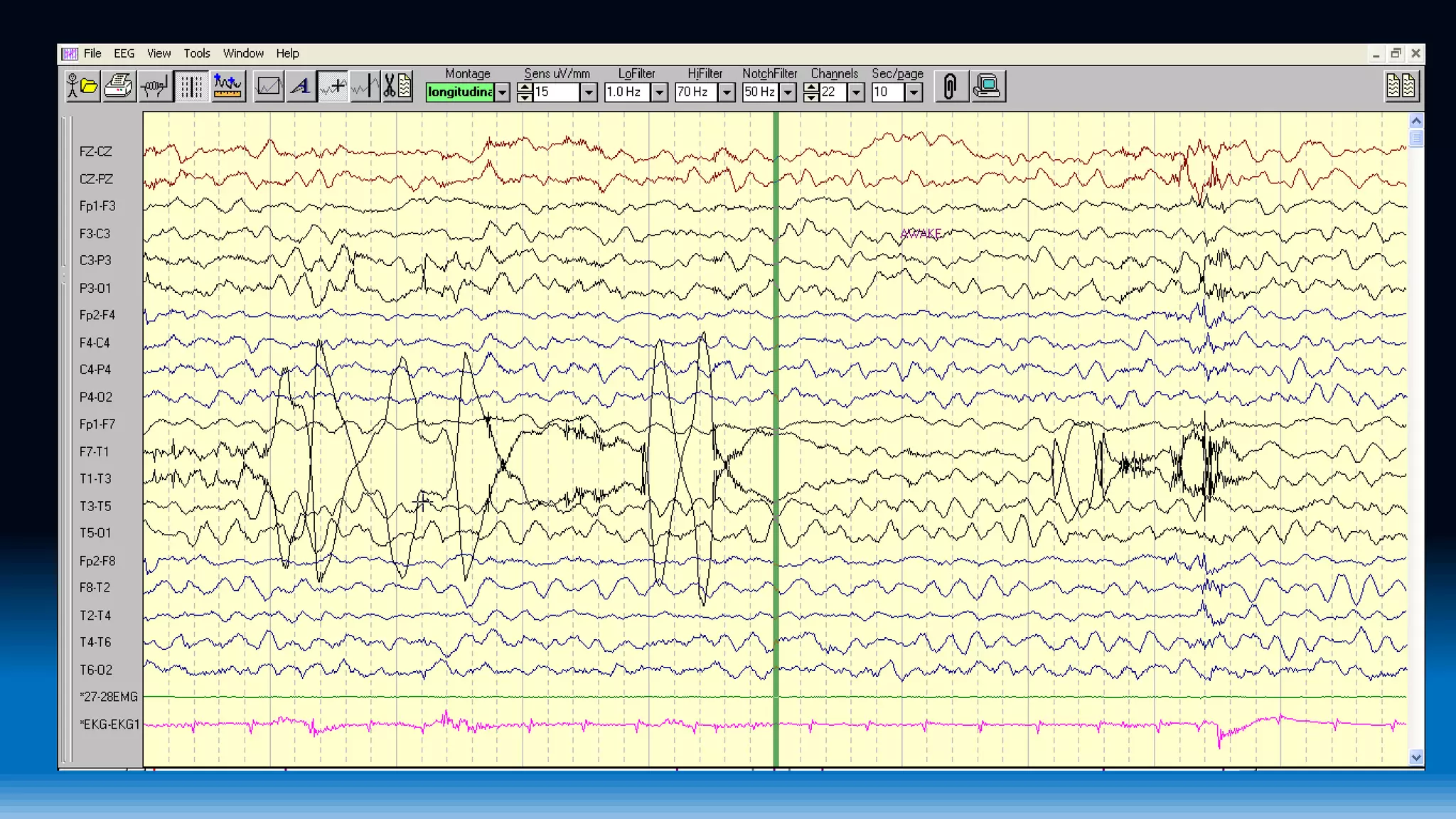 Normal EEG waveforms.pptx | Brain and Nervous System Disorders | Diseases and Conditions