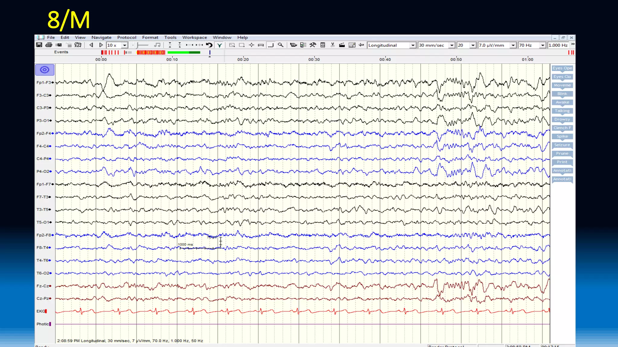 Normal EEG waveforms.pptx