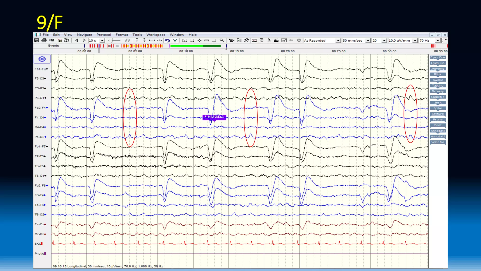 Normal EEG waveforms.pptx