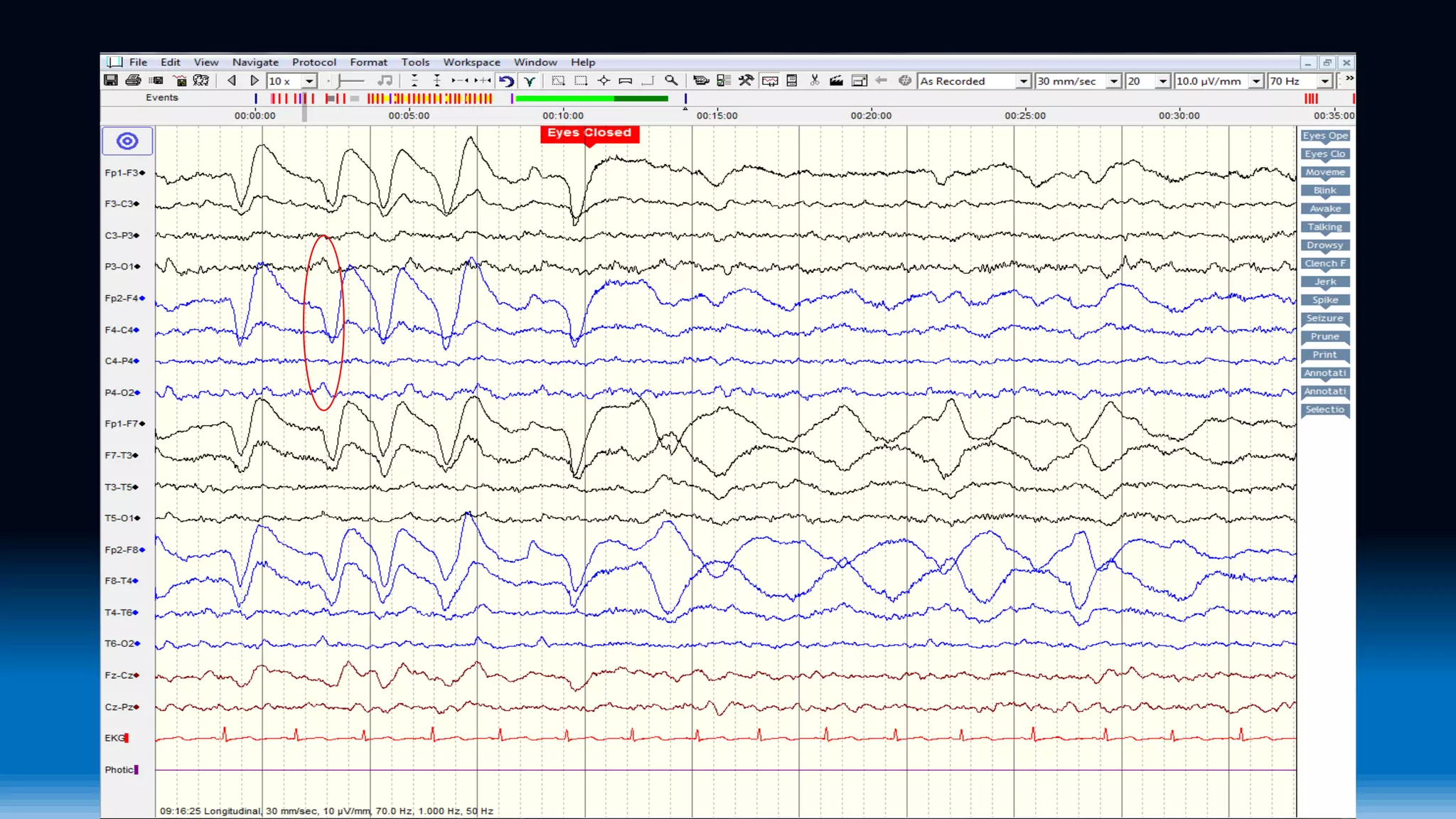Normal EEG waveforms.pptx | Brain and Nervous System Disorders | Diseases and Conditions