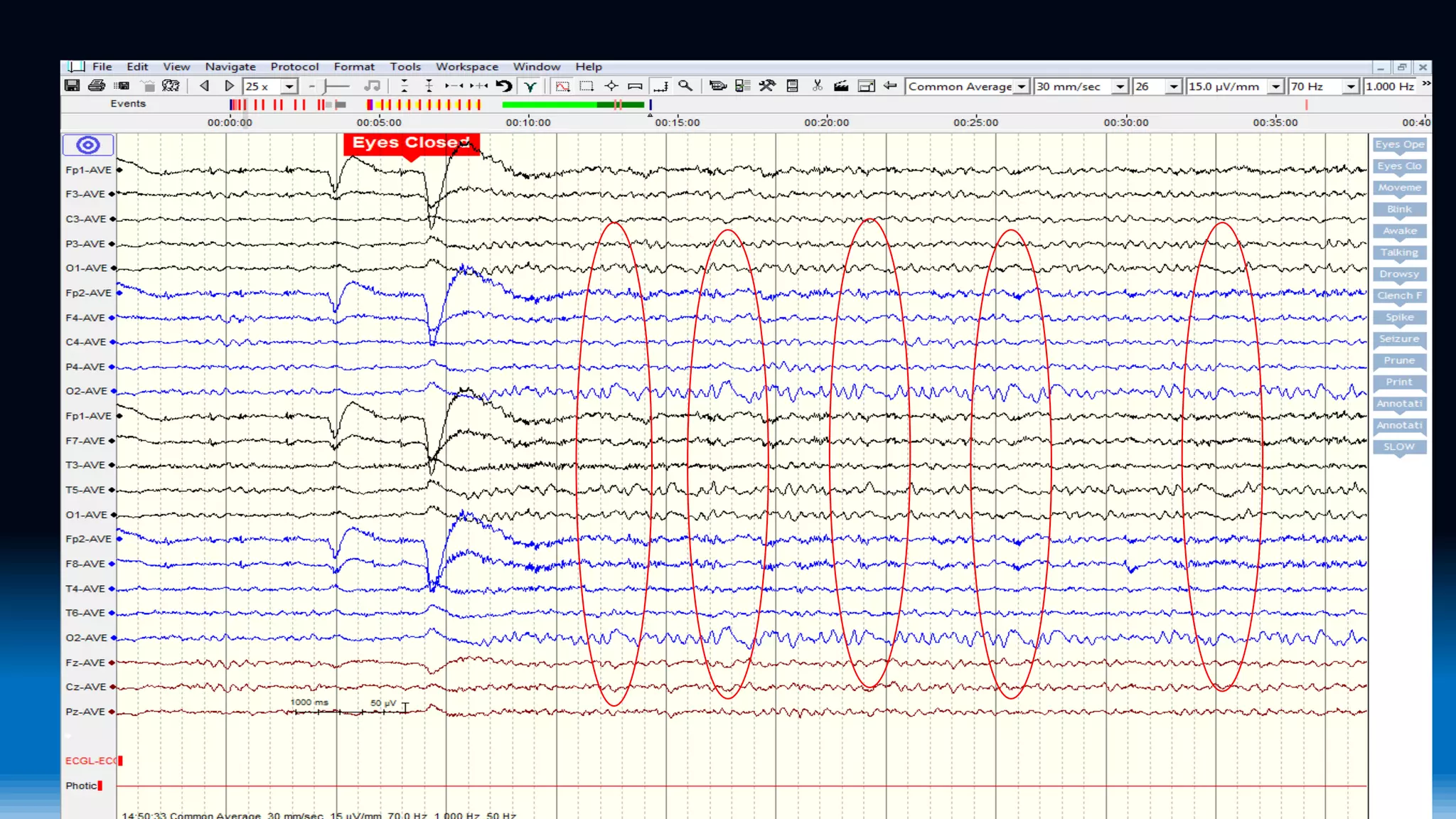Normal EEG waveforms.pptx | Brain and Nervous System Disorders ...