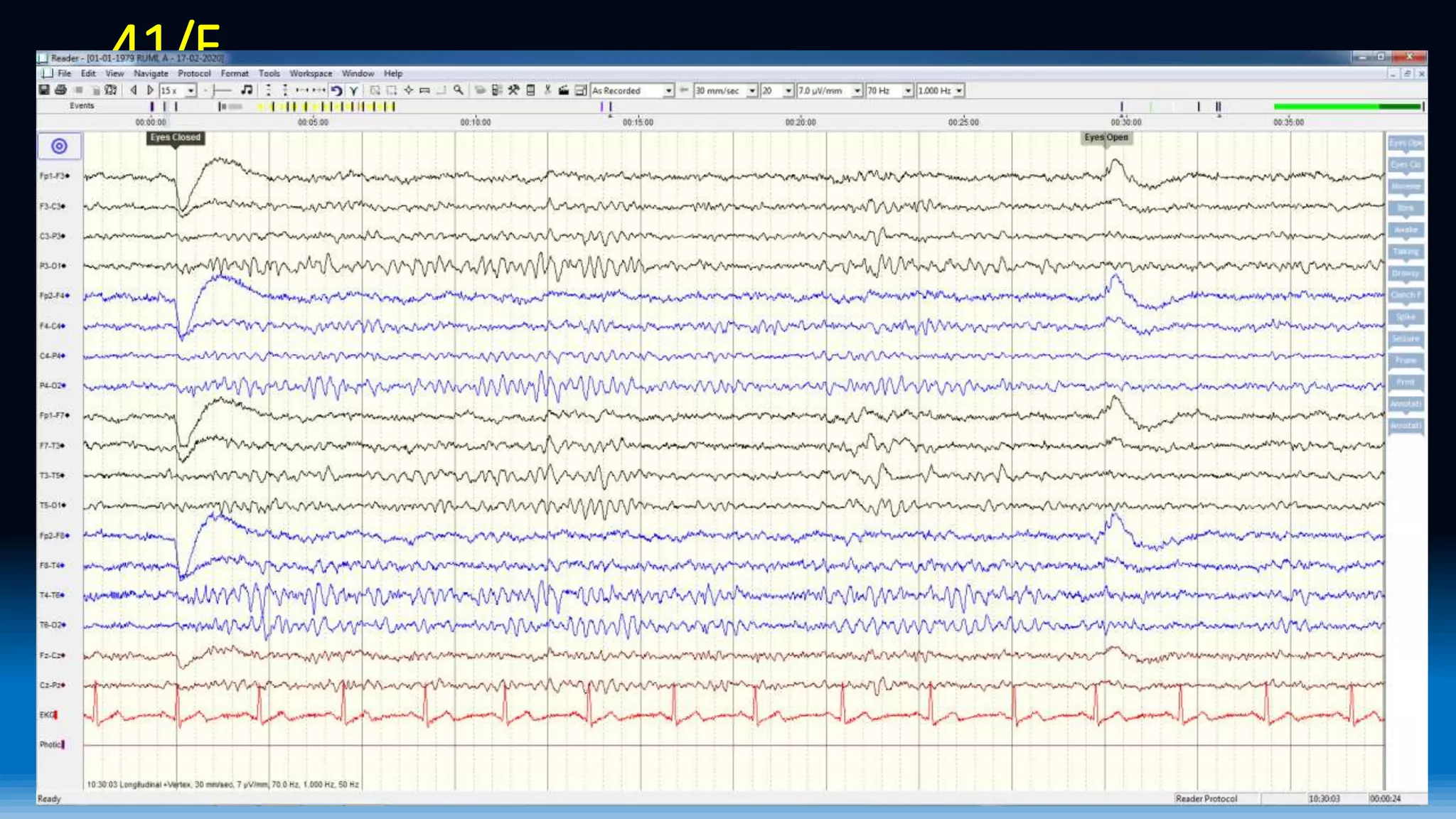 Normal EEG waveforms.pptx